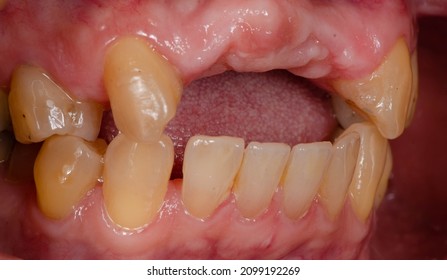 Loss Front Teeth Missing Teeth Because Stock Photo (Edit Now) 2099192269