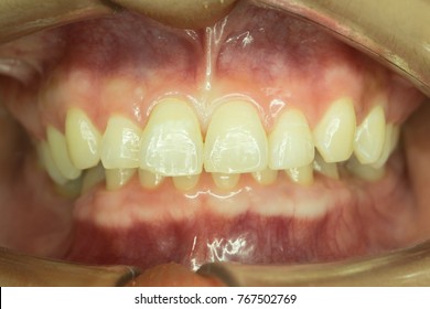Lower Front Teeth Closed Upper Front Stock Photo 767502769 | Shutterstock