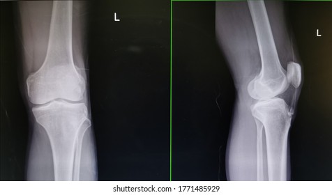 Xray Knee Joint Advanced Osteoarthritis Stock Photo (Edit Now) 267273653