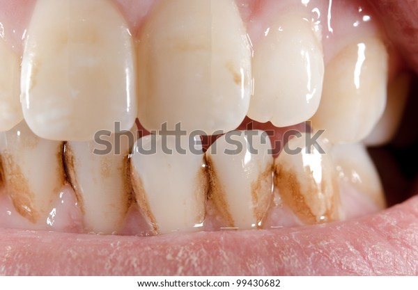 Macro Dirty Aged Front Teeth Lower Stock Photo (Edit Now) 99430682