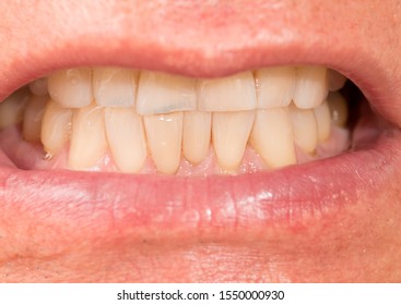 Yellow Teeth Yellow Bad Teeth Man Stock Photo (Edit Now) 1559390660