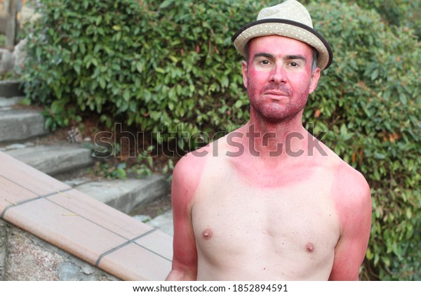 Man Pale Complexion Getting Sunburnt Stock Photo (Edit Now) 1852894591