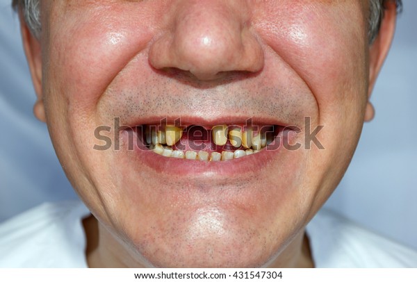 Man Without Two Teeth Peeled Upper Stock Photo 431547304 | Shutterstock
