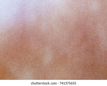 Allergic Skin Rash Red Stock Photo 260305880 | Shutterstock
