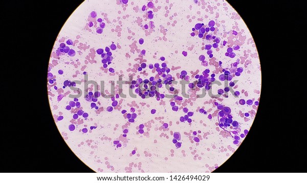 Microscope Slide Acute Leukemia Stock Photo (Edit Now) 1426494029