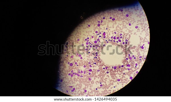 Microscope Slide Acute Leukemia Stock Photo (Edit Now) 1426494035