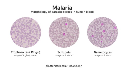 Microscopic Examination Blood Films Malaria Infected Stock Photo (Edit ... Microscopic Examination Blood Films Malaria Infected Stock Photo (Edit ...