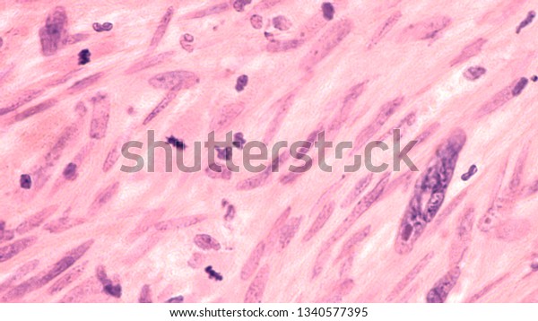 Imagen microscópica de un leiomiosarcoma, un : Foto de stock (editar ...