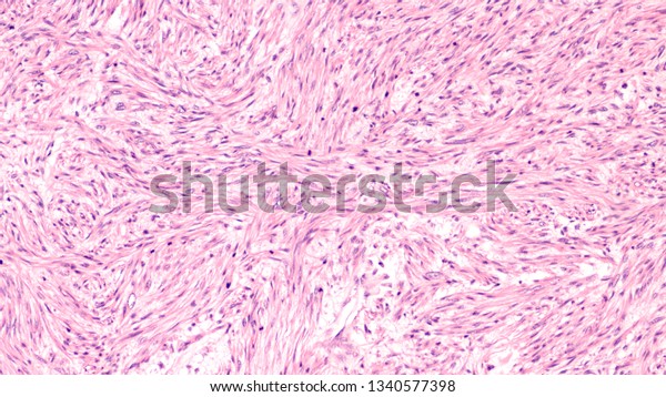 Microscopic Image Leiomyosarcoma Type Soft Tissue Stock Photo ...
