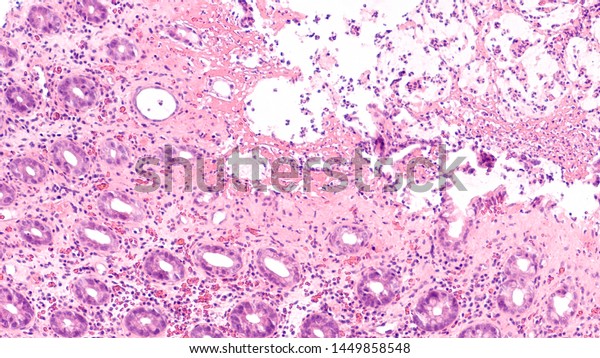 Microscopic Image Photomicrograph Colon Biopsy Showing Stock Photo ... Microscopic Image Photomicrograph Colon Biopsy Showing Stock Photo ...