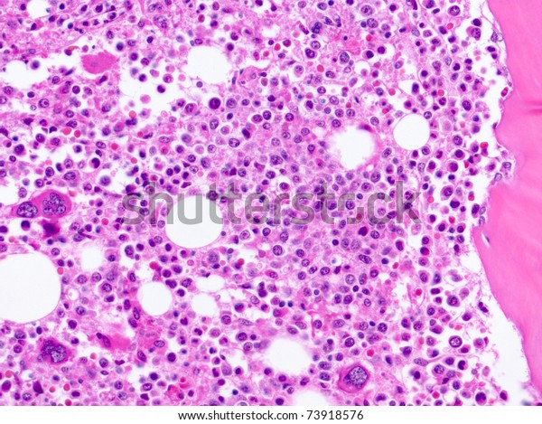 Microscopic View Bone Marrow Biopsy Myelodysplastic Stock Photo (Edit ...