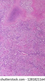 Miliary Tuberculosis Lung Under Microscope Stock Photo 1281821164 ...
