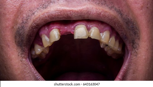 908 Missing teeth man Images, Stock Photos & Vectors | Shutterstock