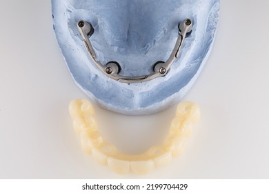 Model Bar Temporary Prosthesis Immediate Loading Stock Photo 2199704429 ...