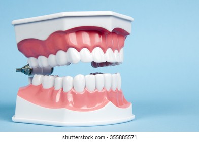 Removable Partial Denture Mandibular Prosthesis Medically Stock ...