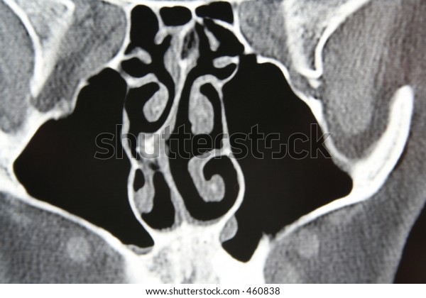 Mri Deviated Septum Stock Photo 460838 | Shutterstock