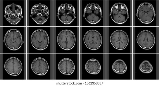 Brain Mri Image Series After Hemorrhagic 스톡 일러스트 1192691203 | Shutterstock
