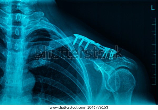 Mri Scan Broken Collar Bone Broken Stock Photo 1046776153 | Shutterstock
