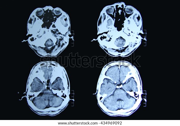 Mri Scan Human Brain Stock Photo 434969092 | Shutterstock
