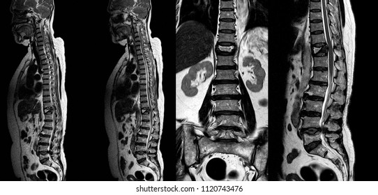 Стоковая фотография 1258976230: Mri Lumbar Spine Scan Sagittal View ...