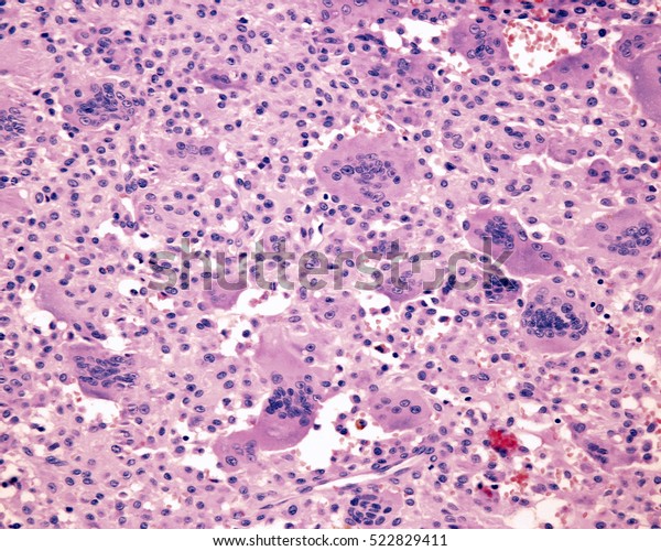Multinucleated Giant Cells Light Micrograph Giant Stock Photo (Edit Now ...