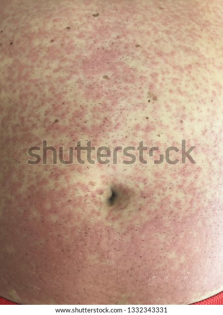 Multiple Erythematous Maculopapular Rash Whole Abdomen Foto De Stock 1332343331 Shutterstock
