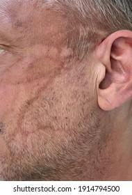 Multiple Linear Lesion Face Unknown Cause Stock Photo 1914794500 ...
