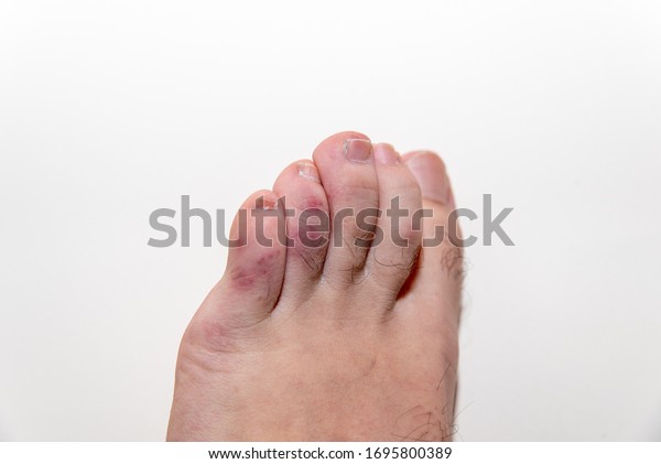 Multiple Spider Bites On Mans Toes Stock Photo 1695800389 | Shutterstock