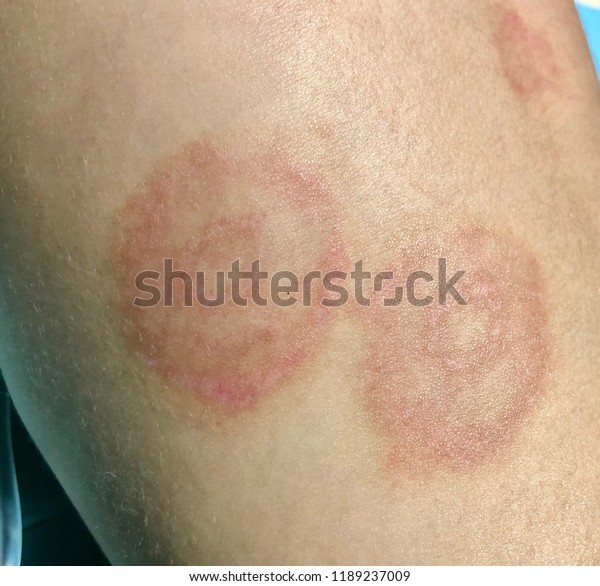 Multiple Target Like Lesion Case Chronic Stock Photo 1189237009 ...