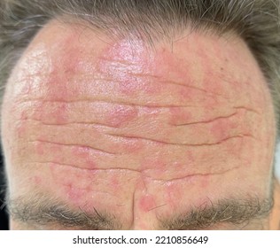 Multiple Welldefine Erythematous Patch Active Border Stock Photo ...