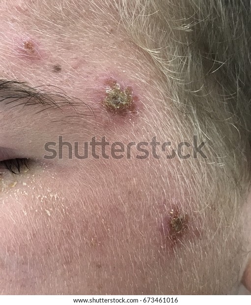 Multiples Impetigo Left Side Face Young Stock Photo (Edit Now) 673461016