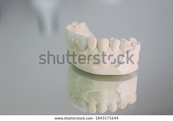 New Front Teeth Plaster Model Dental Stock Photo 1843175644 | Shutterstock