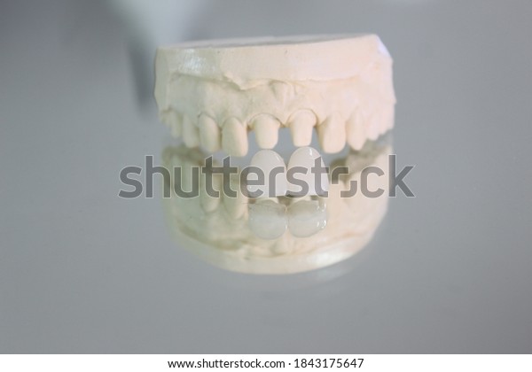 New Front Teeth Plaster Model Dental Stock Photo 1843175647 | Shutterstock