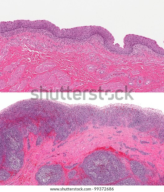 Normal Healthy Urinary Bladder Top Urinary Stock Photo 99372686 ...
