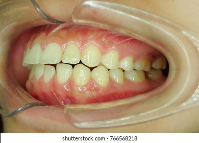 448 Normal bite Images, Stock Photos & Vectors | Shutterstock