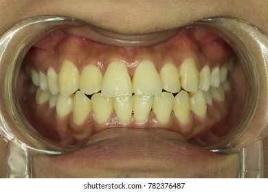 Normal Occlusionfront View Stock Photo 782376487 | Shutterstock