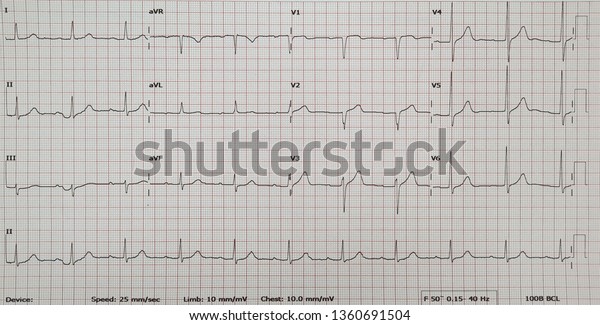 Normal Sinus Rhythm Stock Photo (Edit Now) 1360691504