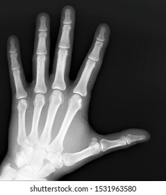 Xray Hand Ring Stock Photo (Edit Now) 1703158216