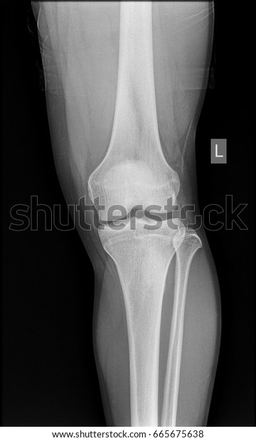 Normal Xrays Human Knee Front View Stock Photo 665675638 | Shutterstock