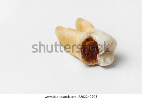 One Tooth Pulled Out Big Hole Stock Photo 2203342903 | Shutterstock