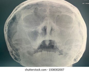 Opacity Left Ethmoid Maxillary Sinuses Mucoperiosteal Stock Photo ...