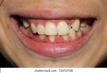 454 Overlapping teeth Stock Photos, Images & Photography | Shutterstock