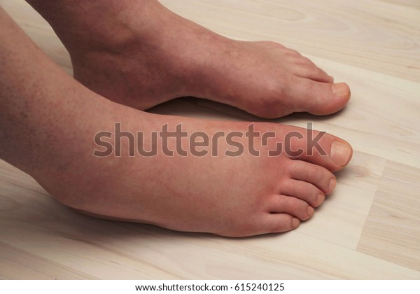 Painful Allergic Reaction Foot Due Wasp Stock Photo (Edit Now) 615240125 Painful Allergic Reaction Foot Due Wasp Stock Photo (Edit Now) 615240125