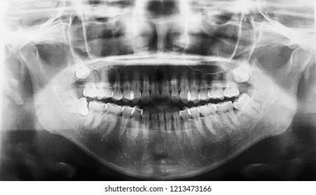 116 Impacted Teeth Panoramic X Ray Images, Stock Photos & Vectors ...