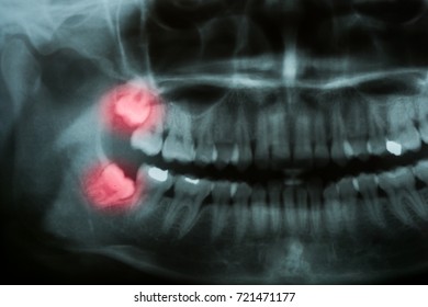 116 Impacted Teeth Panoramic X Ray Images, Stock Photos & Vectors ...