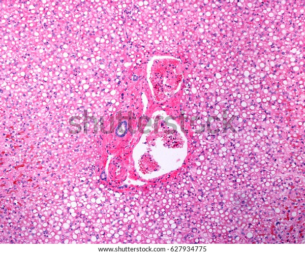 Parenchyma Liver Affected By Diffuse Fatty Stock Photo (Edit Now) 627934775