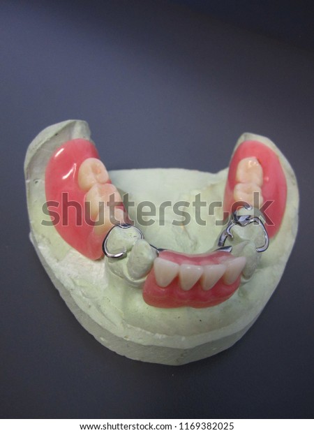 Partial Denture Model Stock Photo 1169382025 | Shutterstock