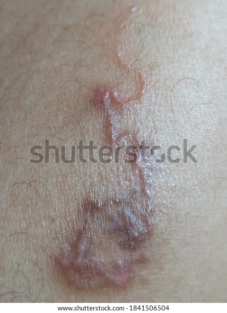 Foto Stok Patterns That Form Under Skin Due (Edit Sekarang) 1841506504