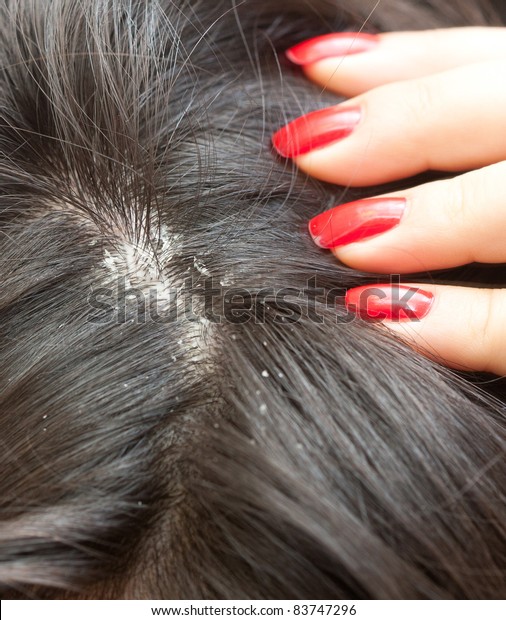 Persistent Dandruff Issue Flaky Scalp Stock Photo (Edit Now) 83747296