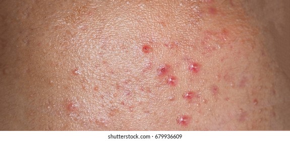 Pimples Stock Photo 679936609 | Shutterstock